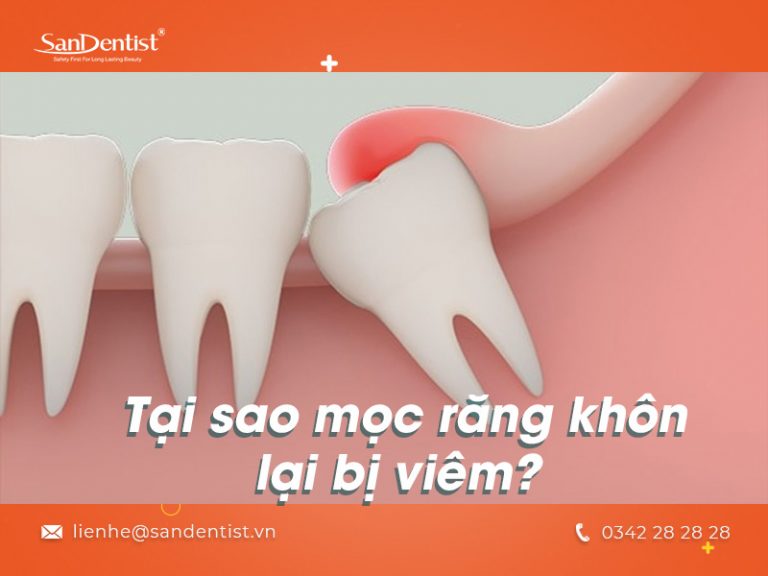 5 cách xử lý viêm răng khôn bạn không thể bỏ qua