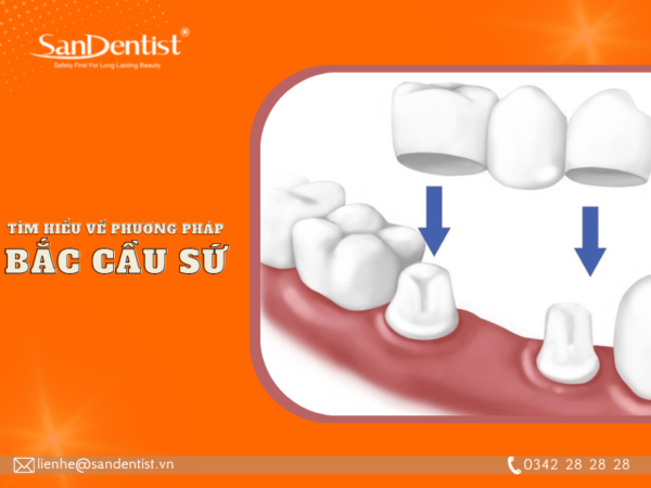 Giải đáp thắc mắc: Bắc cầu răng sứ là gì?