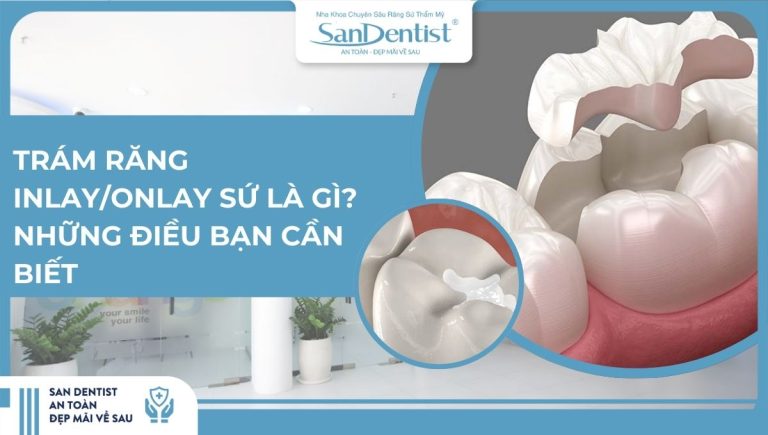 Trám răng Inlay/Onlay sứ là gì? Những điều bạn cần biết